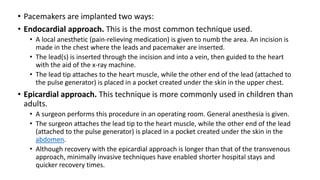 Implanted devices | PPT