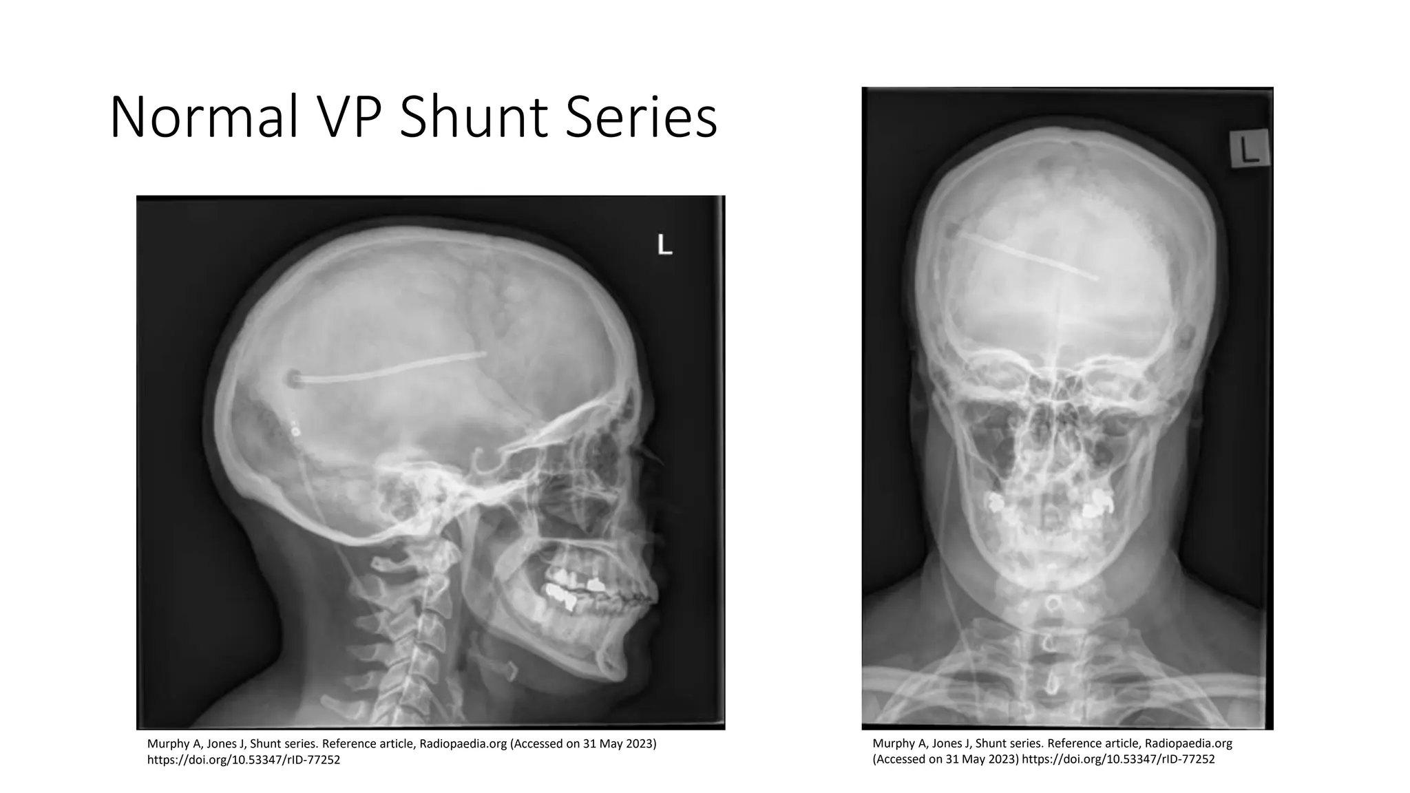 Implanted Devices - VP Shunts: EMGuidewire's Radiology Reading Room | PPTX