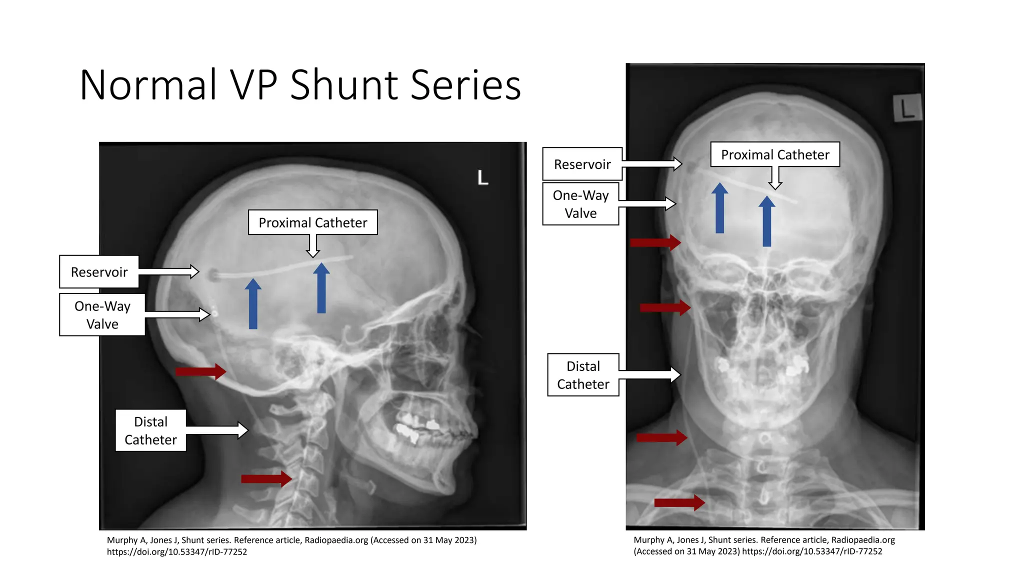 Implanted Devices - VP Shunts: EMGuidewire's Radiology Reading Room | PPTX