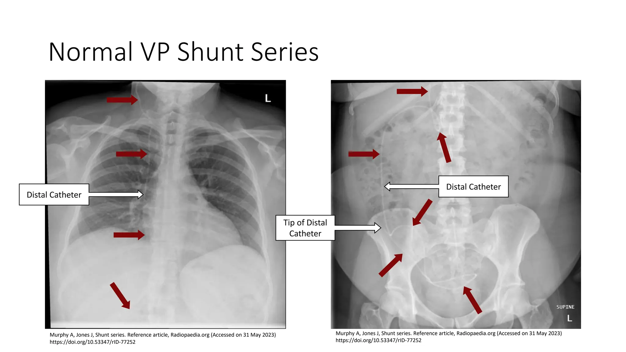 Implanted Devices - VP Shunts: EMGuidewire's Radiology Reading Room | PPTX