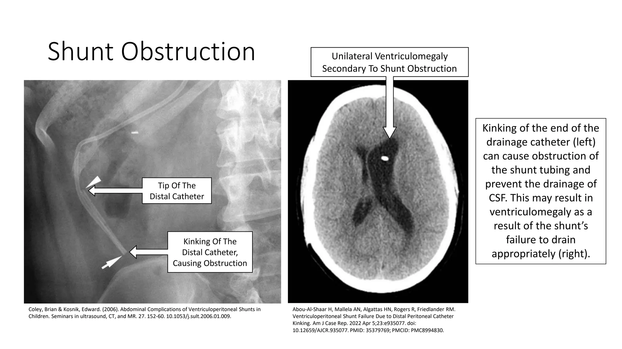Implanted Devices - VP Shunts: EMGuidewire's Radiology Reading Room | PPTX