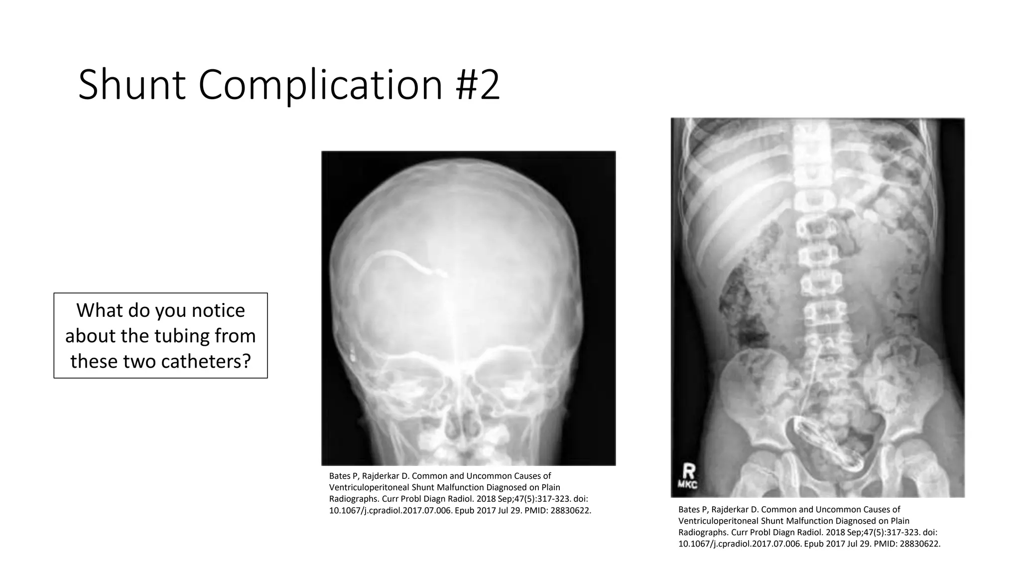 Implanted Devices - VP Shunts: EMGuidewire's Radiology Reading Room | PPTX
