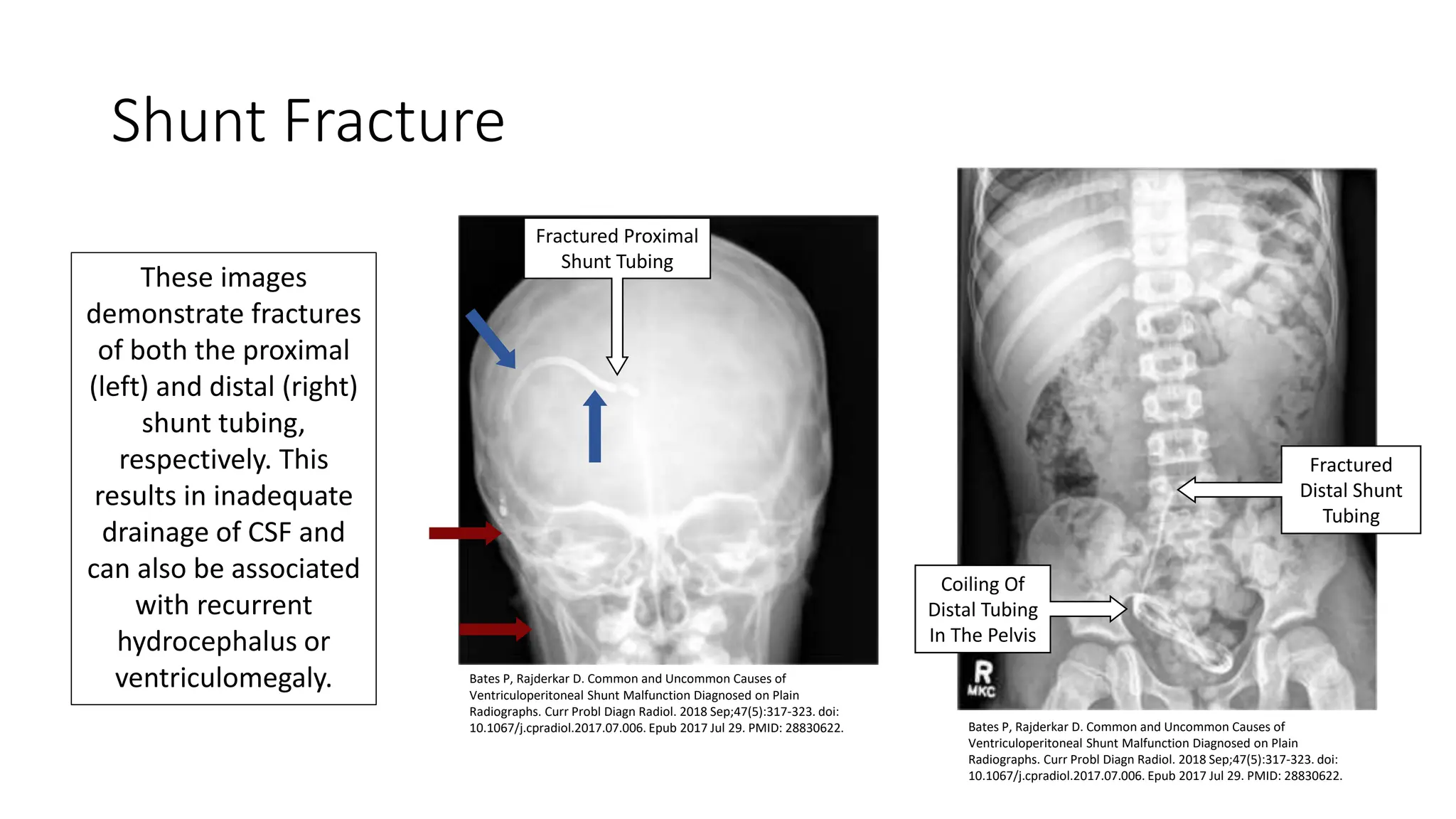 Implanted Devices - VP Shunts: EMGuidewire's Radiology Reading Room | PPTX