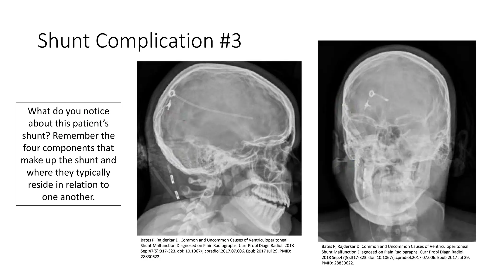 Implanted Devices - VP Shunts: EMGuidewire's Radiology Reading Room | PPTX