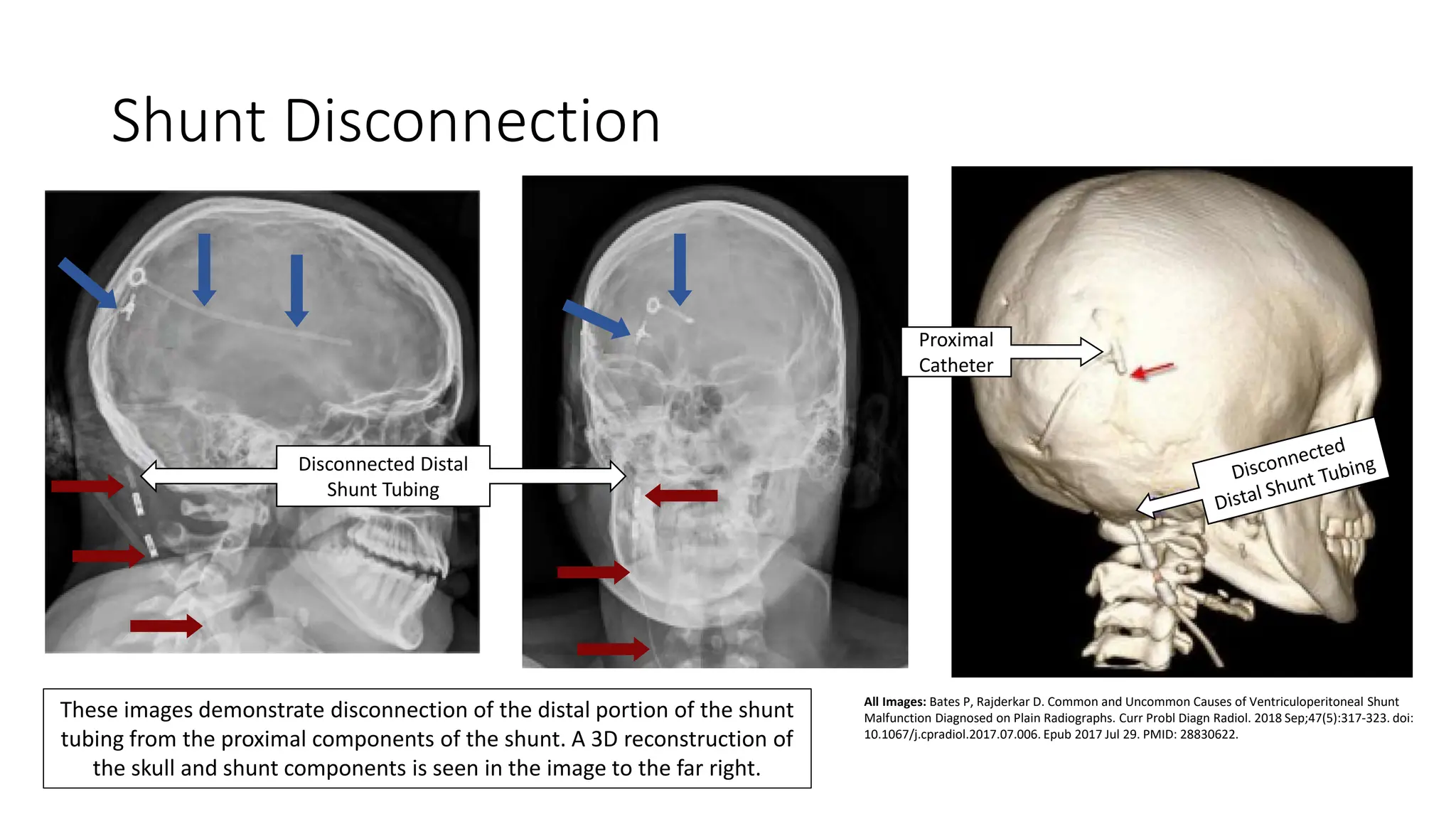 Implanted Devices - VP Shunts: EMGuidewire's Radiology Reading Room | PPTX