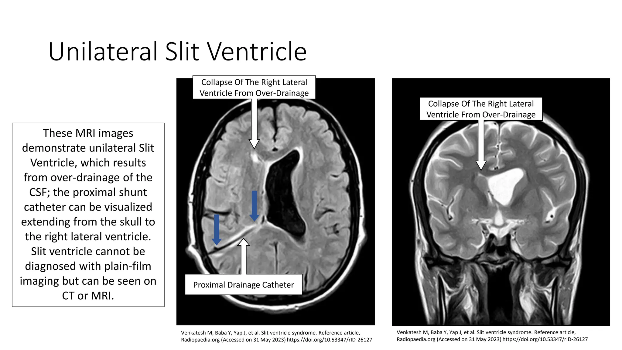 Implanted Devices - VP Shunts: EMGuidewire's Radiology Reading Room | PPTX