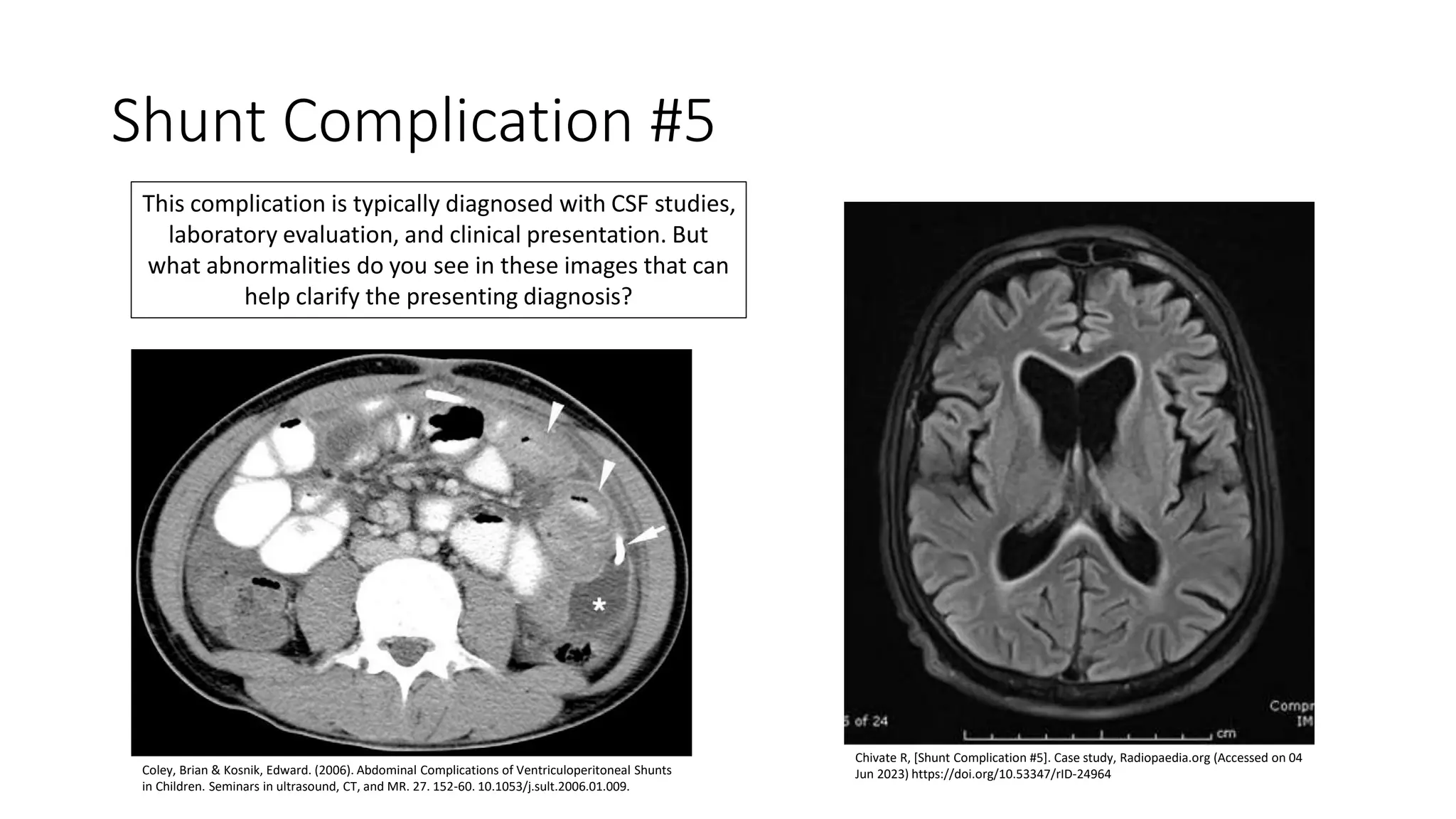 Implanted Devices - VP Shunts: EMGuidewire's Radiology Reading Room | PPTX