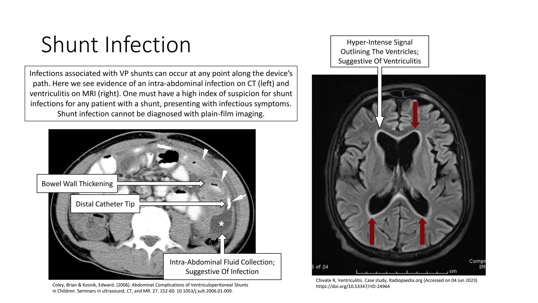 Implanted Devices - VP Shunts: EMGuidewire's Radiology Reading Room | PPTX