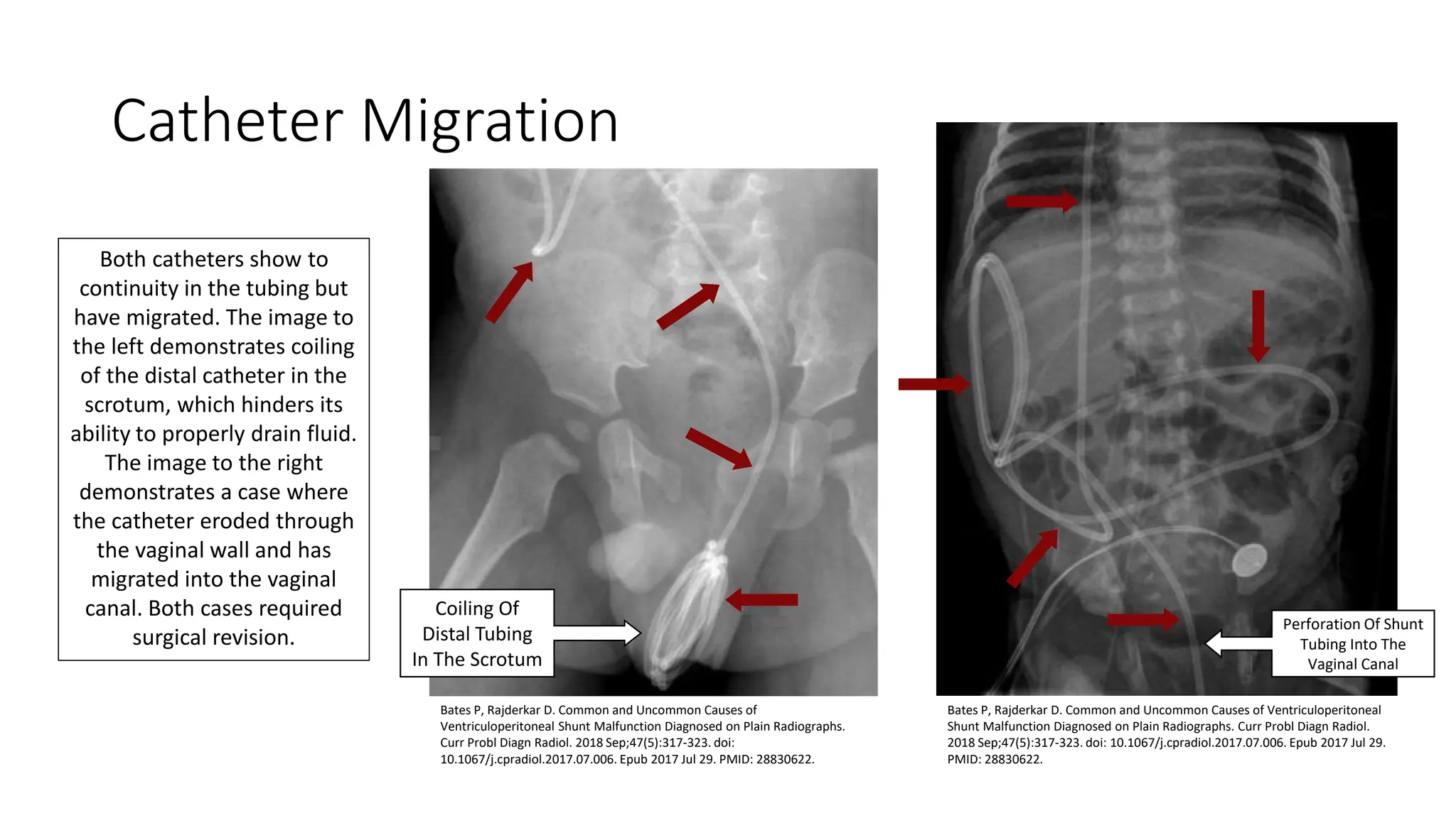 Implanted Devices - VP Shunts: EMGuidewire's Radiology Reading Room | PPTX