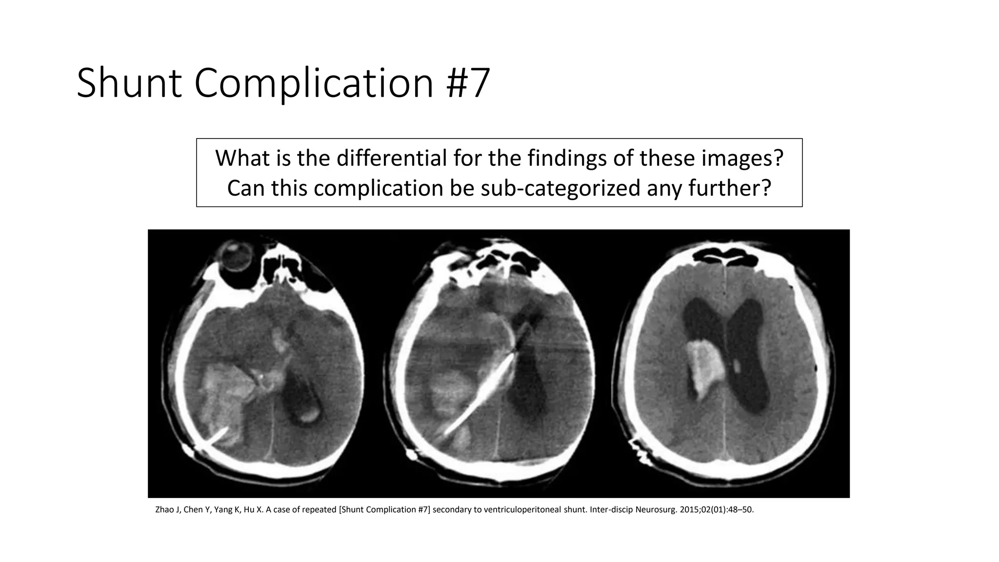 Implanted Devices - VP Shunts: EMGuidewire's Radiology Reading Room | PPTX