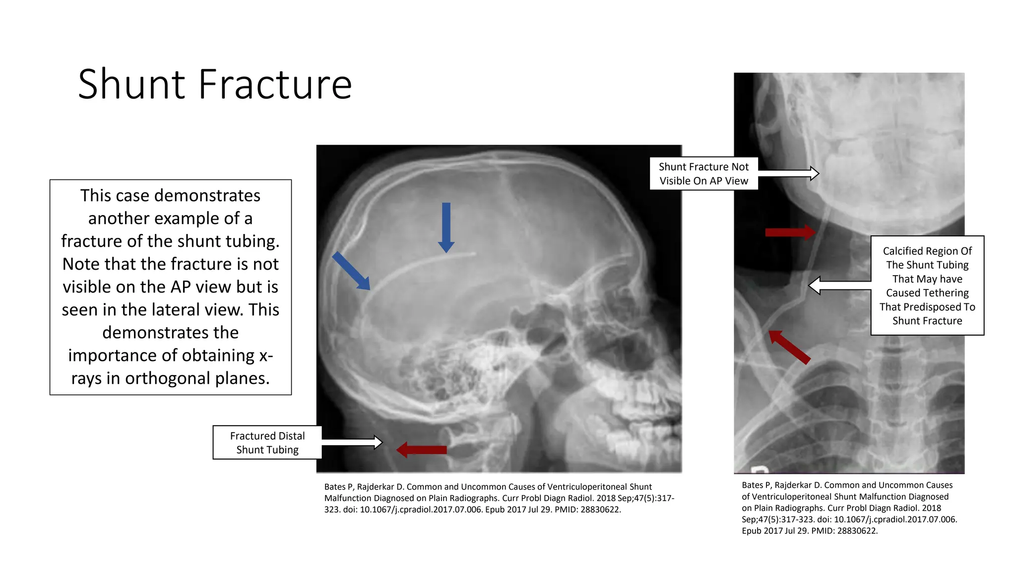 Implanted Devices - VP Shunts: EMGuidewire's Radiology Reading Room | PPTX