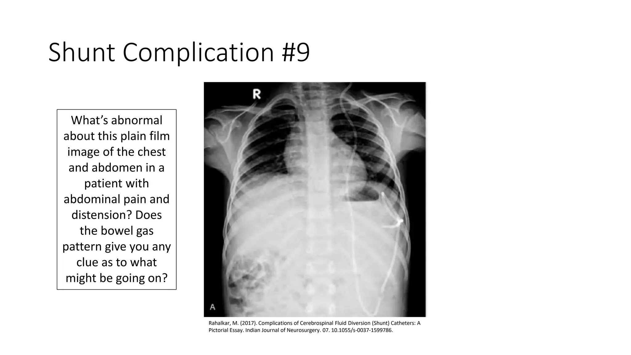 Implanted Devices - VP Shunts: EMGuidewire's Radiology Reading Room | PPTX