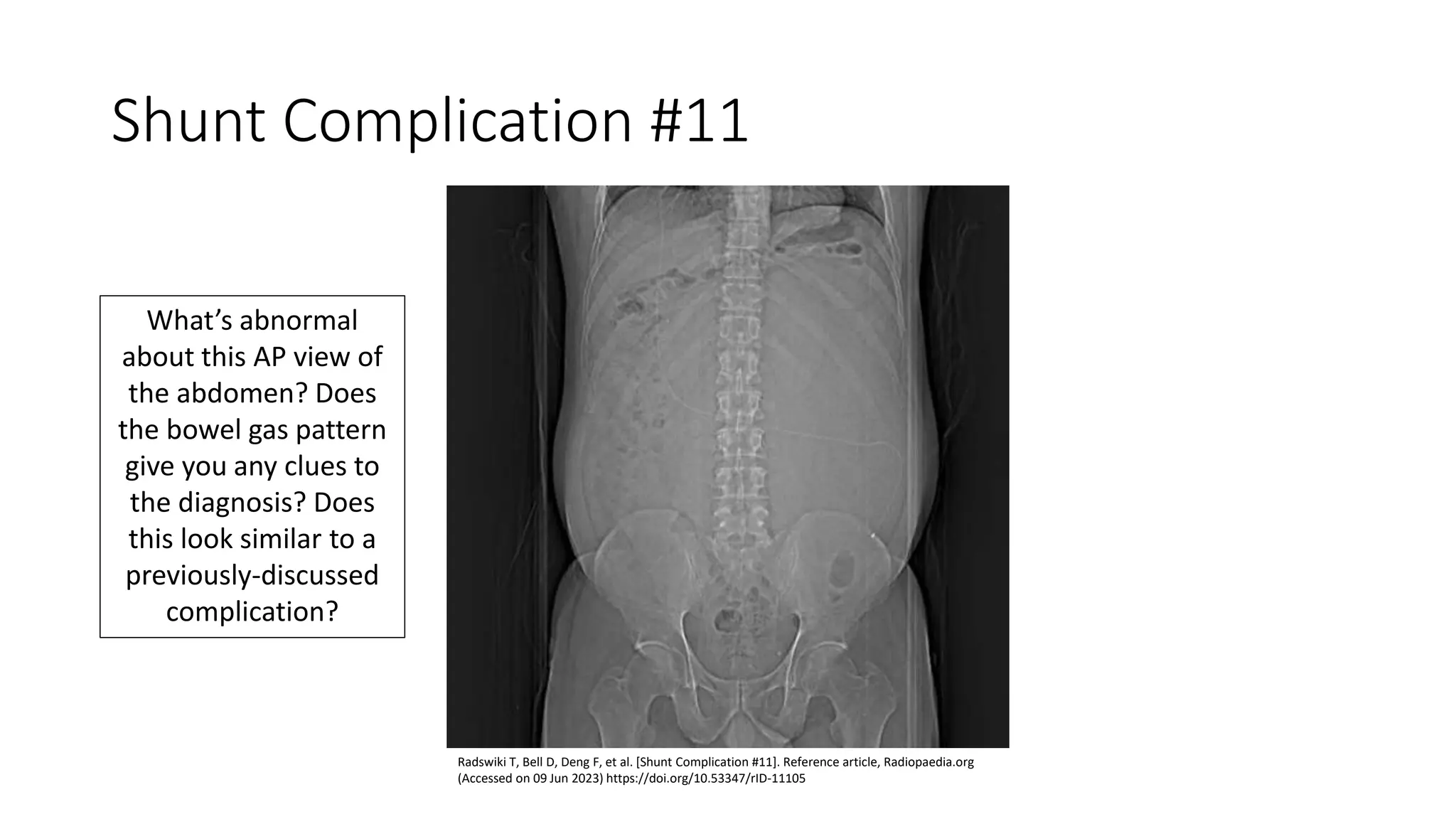 Implanted Devices - VP Shunts: EMGuidewire's Radiology Reading Room | PPTX