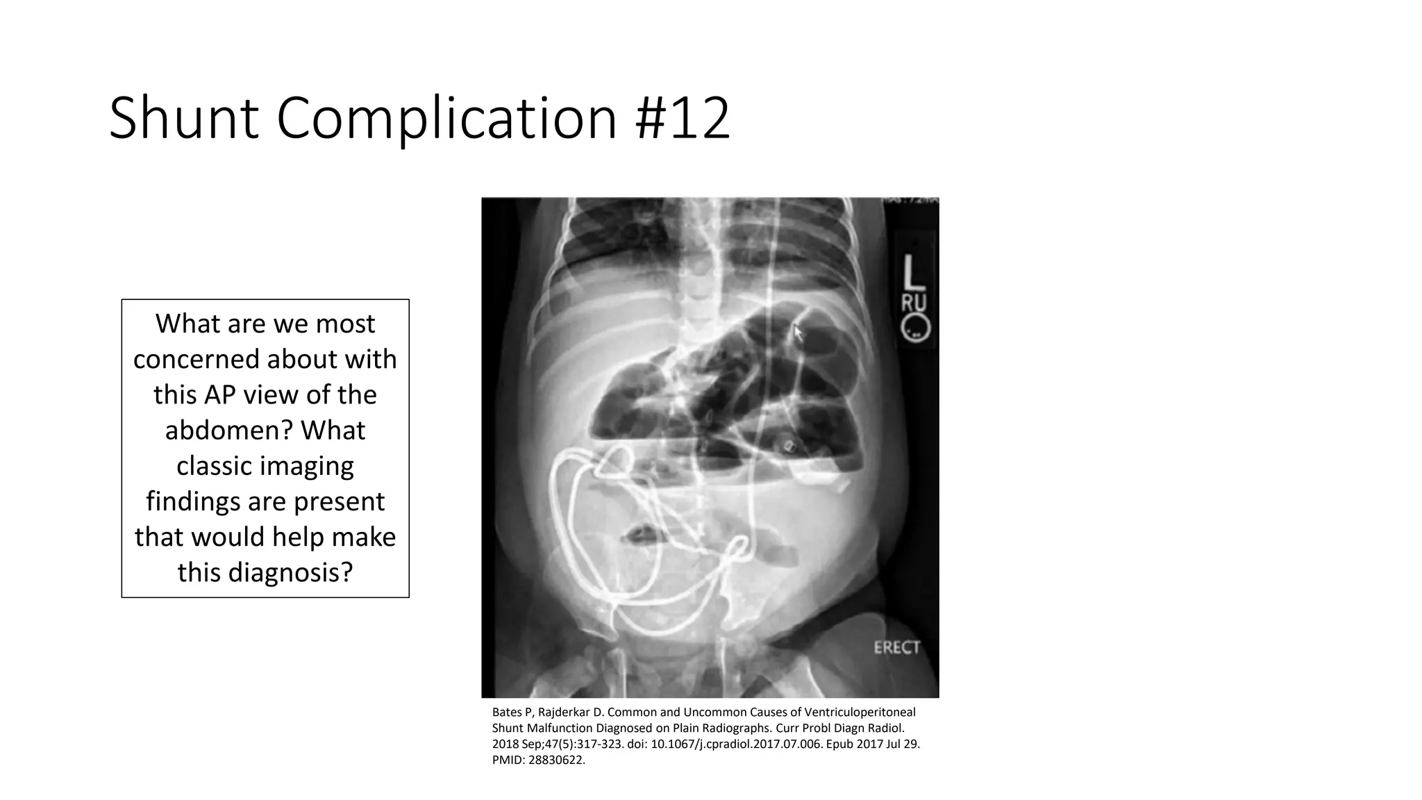 Implanted Devices - VP Shunts: EMGuidewire's Radiology Reading Room | PPTX