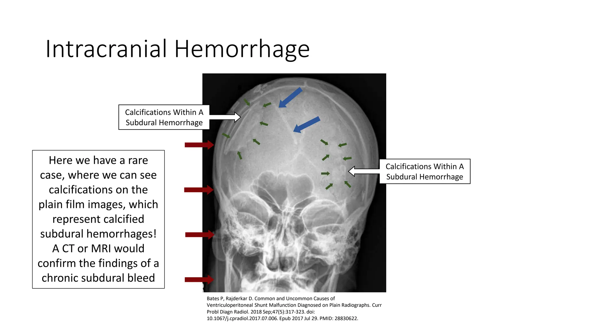 Implanted Devices - VP Shunts: EMGuidewire's Radiology Reading Room | PPTX