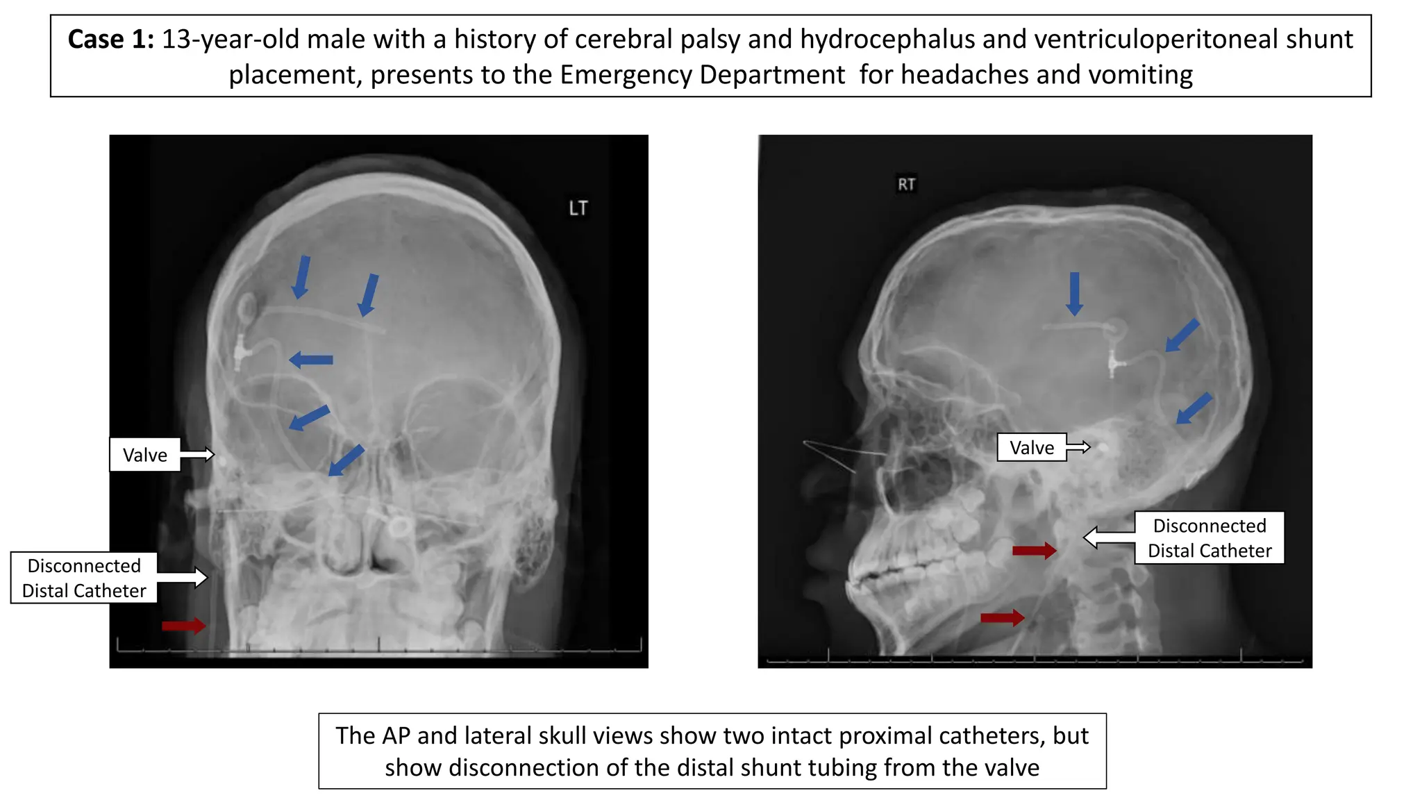Implanted Devices - VP Shunts: EMGuidewire's Radiology Reading Room | PPTX