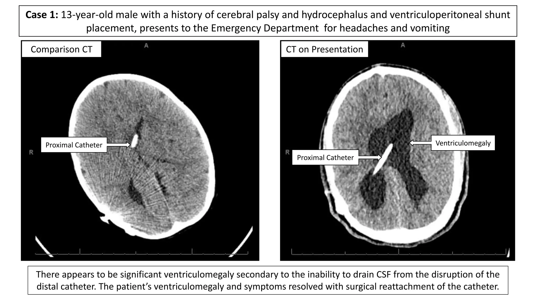 Implanted Devices - VP Shunts: EMGuidewire's Radiology Reading Room | PPTX