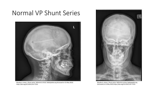 Implanted Devices - VP Shunts: EMGuidewire's Radiology Reading Room | PPT