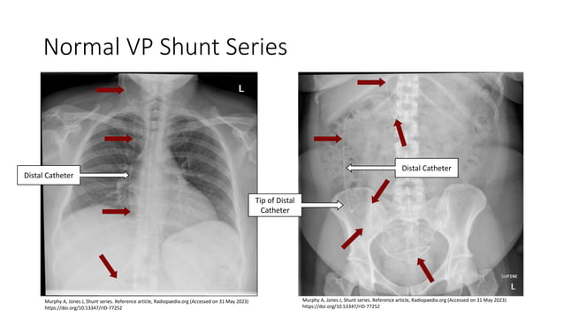 Implanted Devices - VP Shunts: EMGuidewire's Radiology Reading Room | PPT