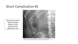 Implanted Devices - VP Shunts: EMGuidewire's Radiology Reading Room | PPTX