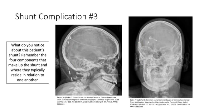 Implanted Devices - VP Shunts: EMGuidewire's Radiology Reading Room | PPT