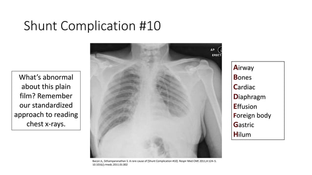 Implanted Devices - VP Shunts: EMGuidewire's Radiology Reading Room | PPT