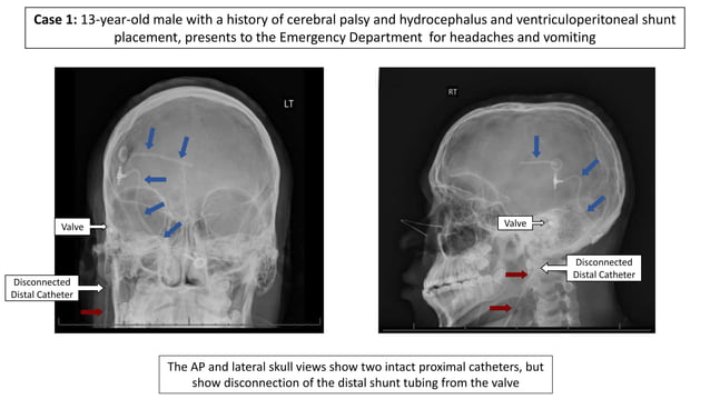 Implanted Devices - VP Shunts: EMGuidewire's Radiology Reading Room | PPT