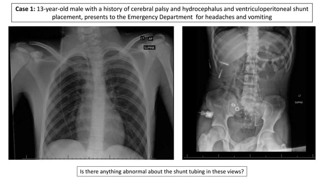 Implanted Devices - VP Shunts: EMGuidewire's Radiology Reading Room | PPT
