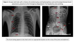 Implanted Devices - VP Shunts: EMGuidewire's Radiology Reading Room | PPTX
