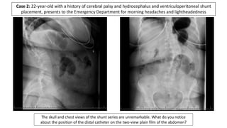 Implanted Devices - VP Shunts: EMGuidewire's Radiology Reading Room | PPTX