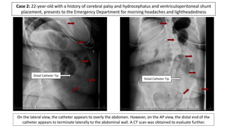 Implanted Devices - VP Shunts: EMGuidewire's Radiology Reading Room | PPTX
