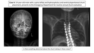 Implanted Devices - VP Shunts: EMGuidewire's Radiology Reading Room | PPTX