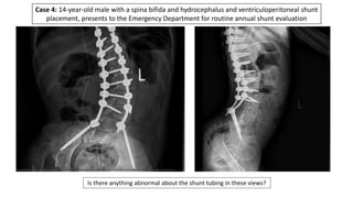 Implanted Devices - VP Shunts: EMGuidewire's Radiology Reading Room | PPTX