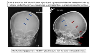 Implanted Devices - VP Shunts: EMGuidewire's Radiology Reading Room | PPTX