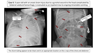 Implanted Devices - VP Shunts: EMGuidewire's Radiology Reading Room | PPTX