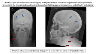 Implanted Devices - VP Shunts: EMGuidewire's Radiology Reading Room | PPTX