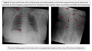 Implanted Devices - VP Shunts: EMGuidewire's Radiology Reading Room | PPTX