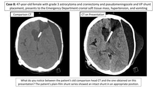 Implanted Devices - VP Shunts: EMGuidewire's Radiology Reading Room | PPTX