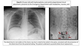 Implanted Devices - VP Shunts: EMGuidewire's Radiology Reading Room | PPTX