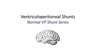 Implanted Devices - VP Shunts: EMGuidewire's Radiology Reading Room | PPTX