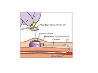 Implanted venous port access | PPTX