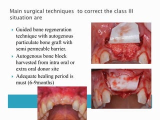 Implant esthetics - Integrated approach | PPTX