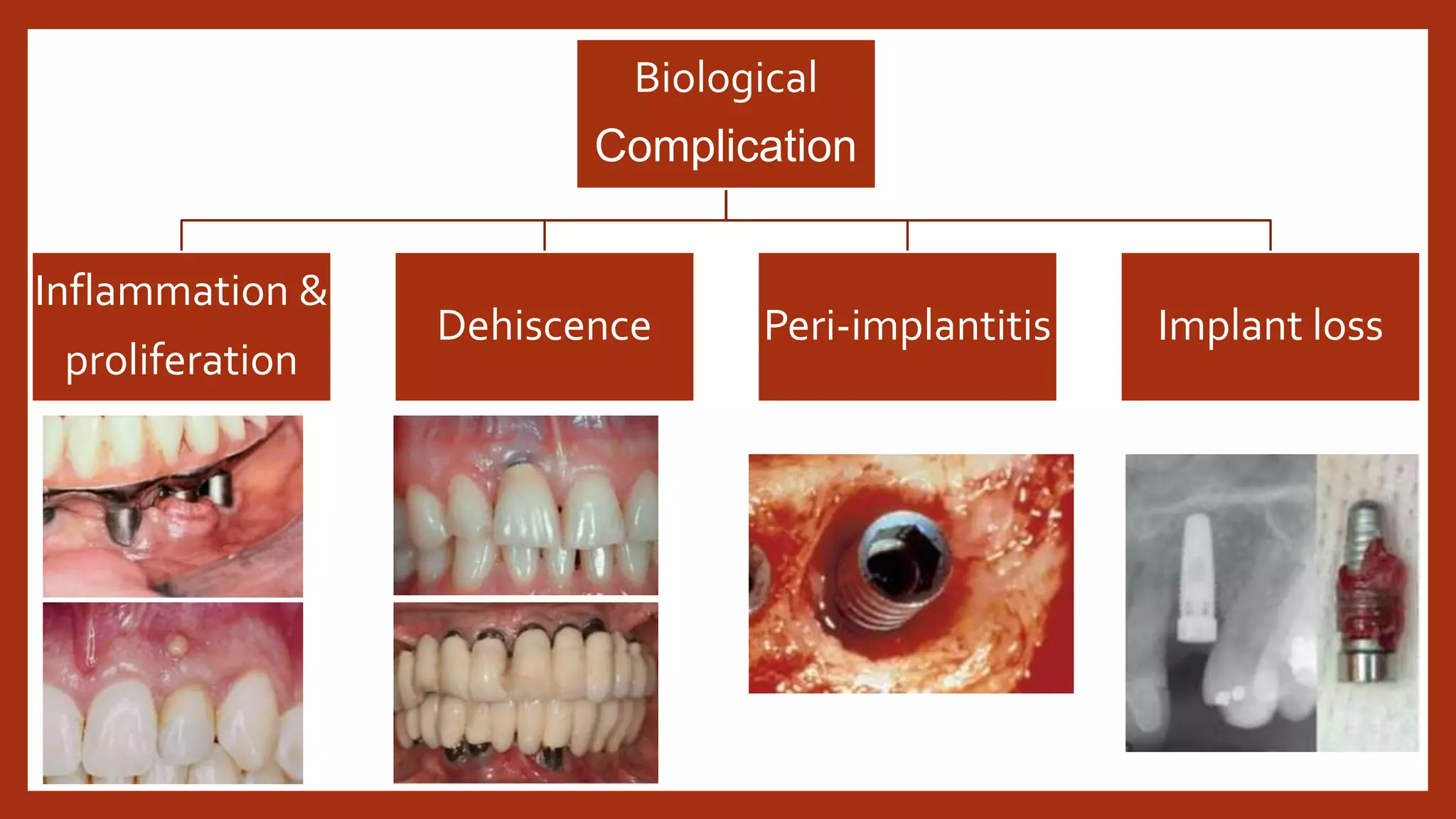 Implant failure & its management.pptx