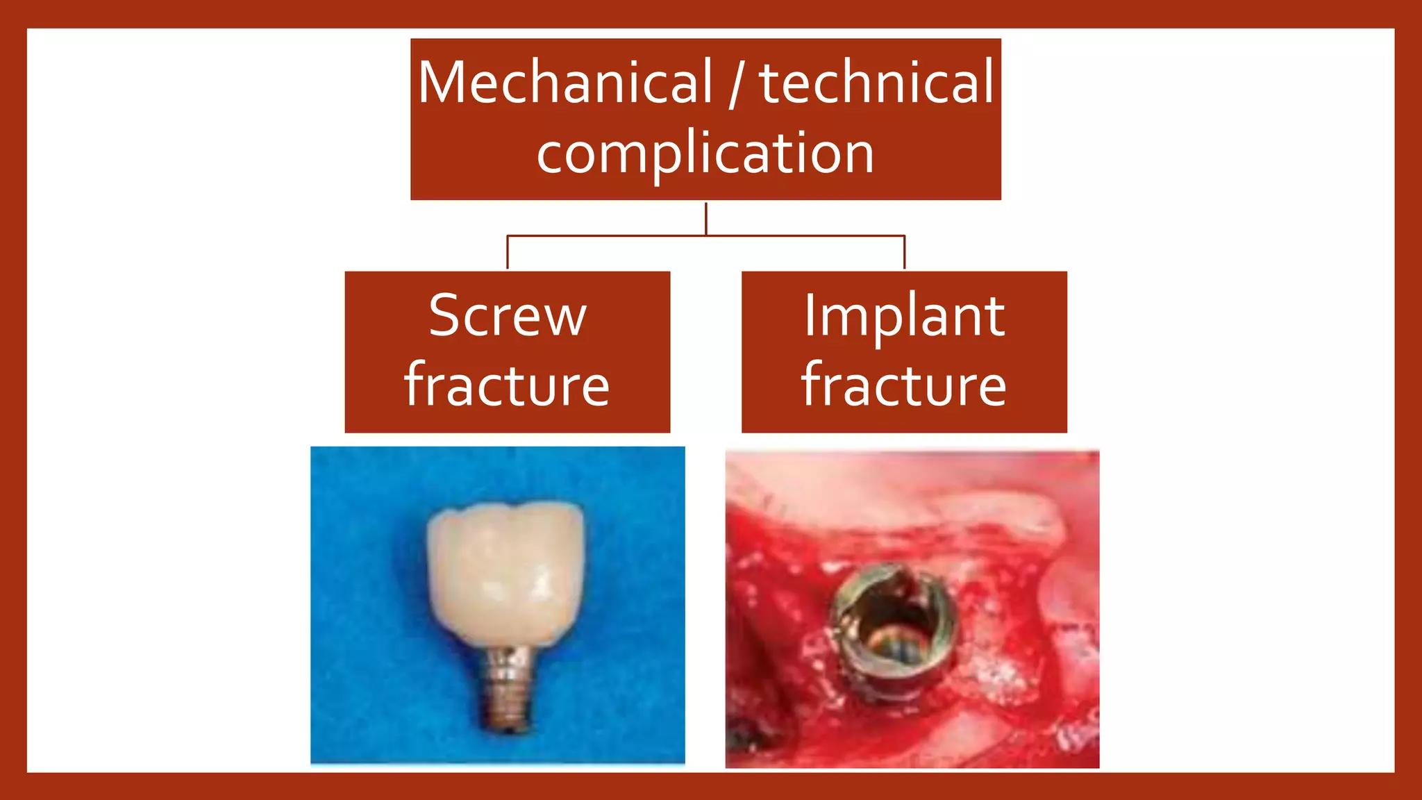 Implant failure & its management.pptx