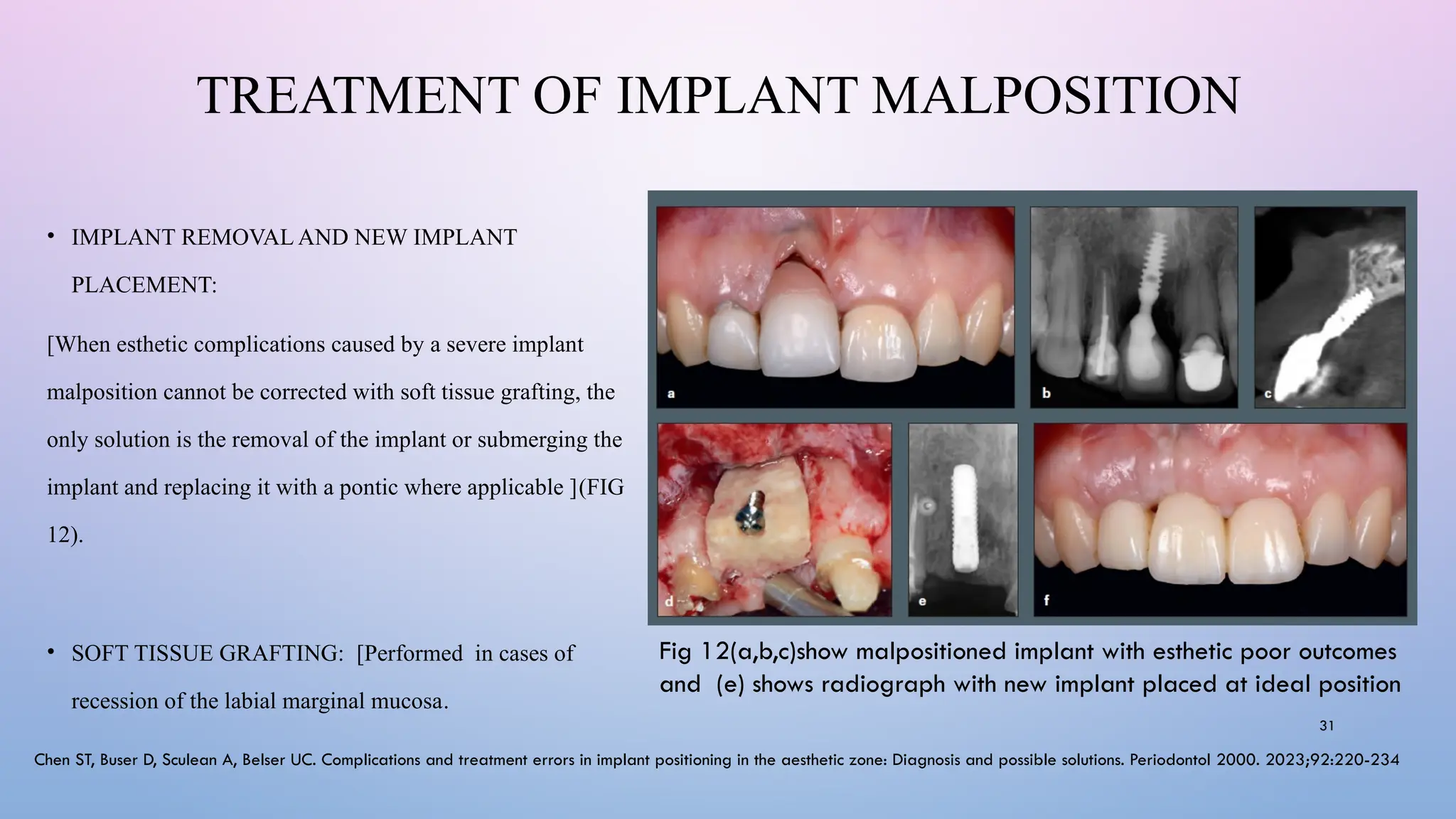 Implant failure & its management (Final).pptx