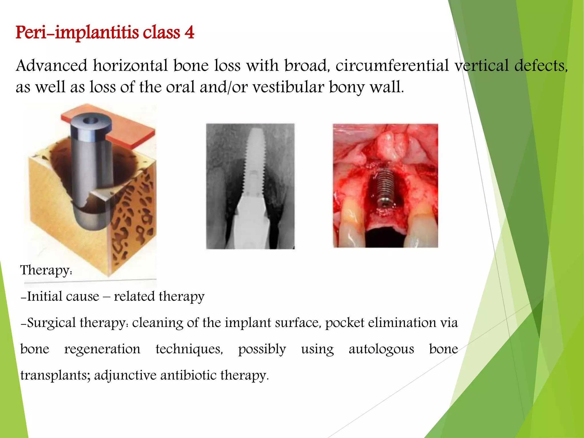implant failure peri implant.pptx