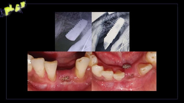 Implant failures complications and management | PPT