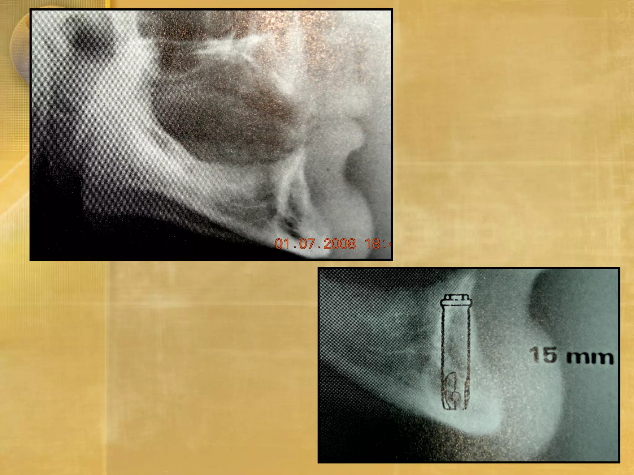 IMPLANT IMAGING TECHNIQUE | PPT