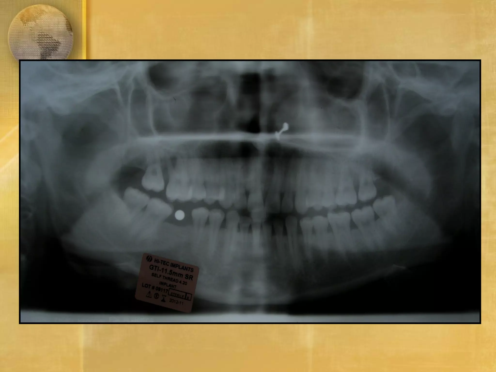 IMPLANT IMAGING TECHNIQUE | PPT