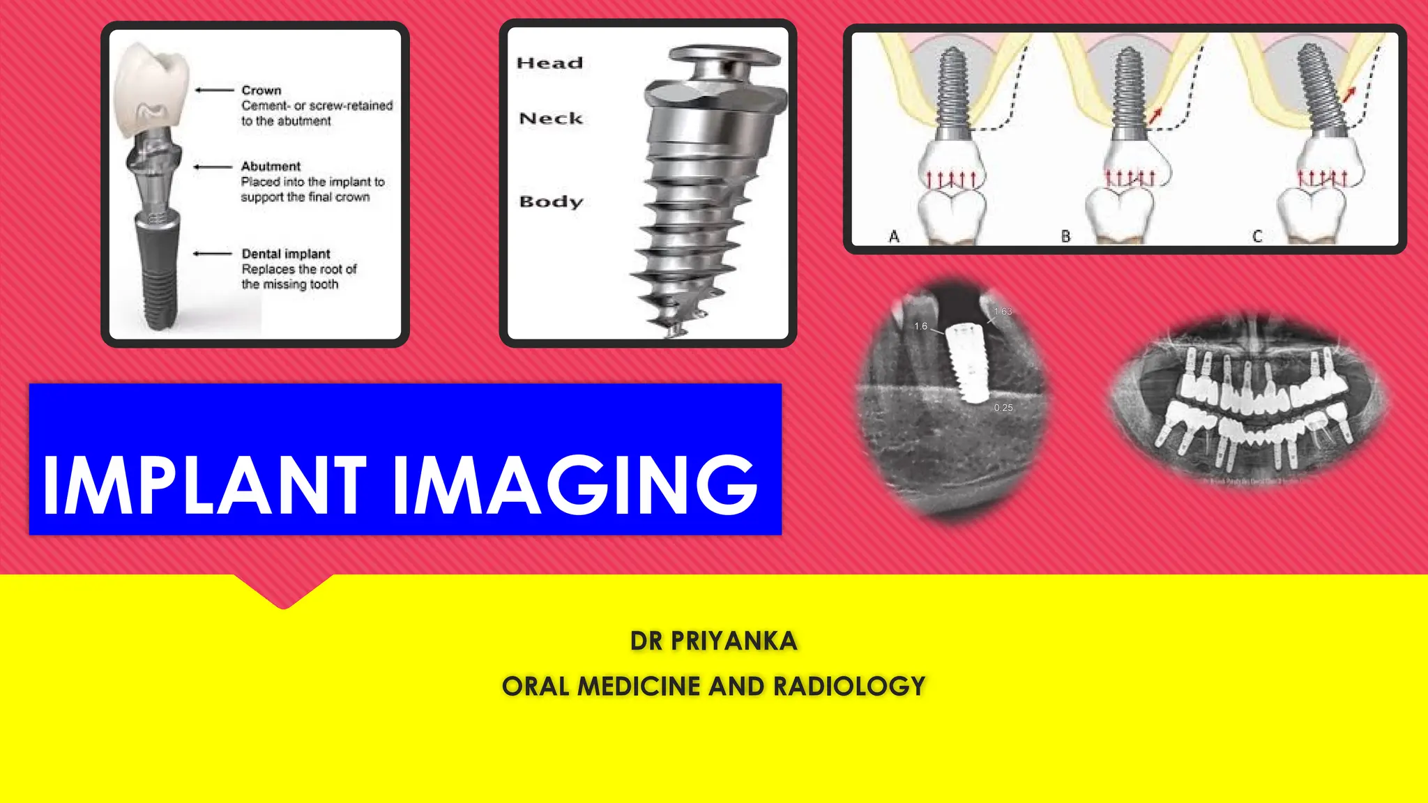 IMPLANT IMAGING (DENTAL IMPLANT IMAGING)- DR PRIYANKA | PPT
